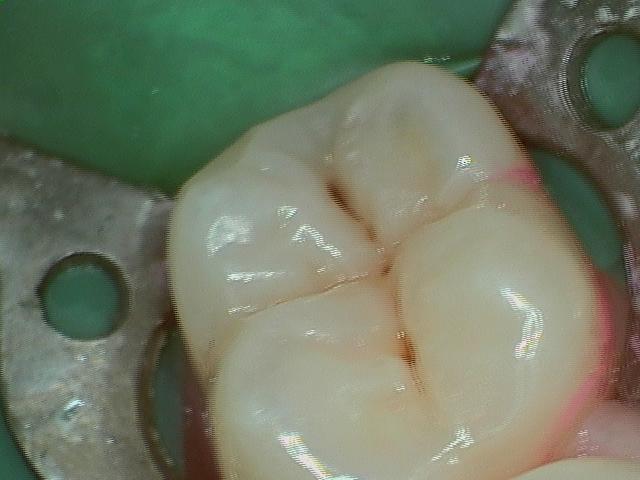 Fillings & Bonding - Michael J. Maser, DMD, MAGD | Myrtle Beach, SC ...